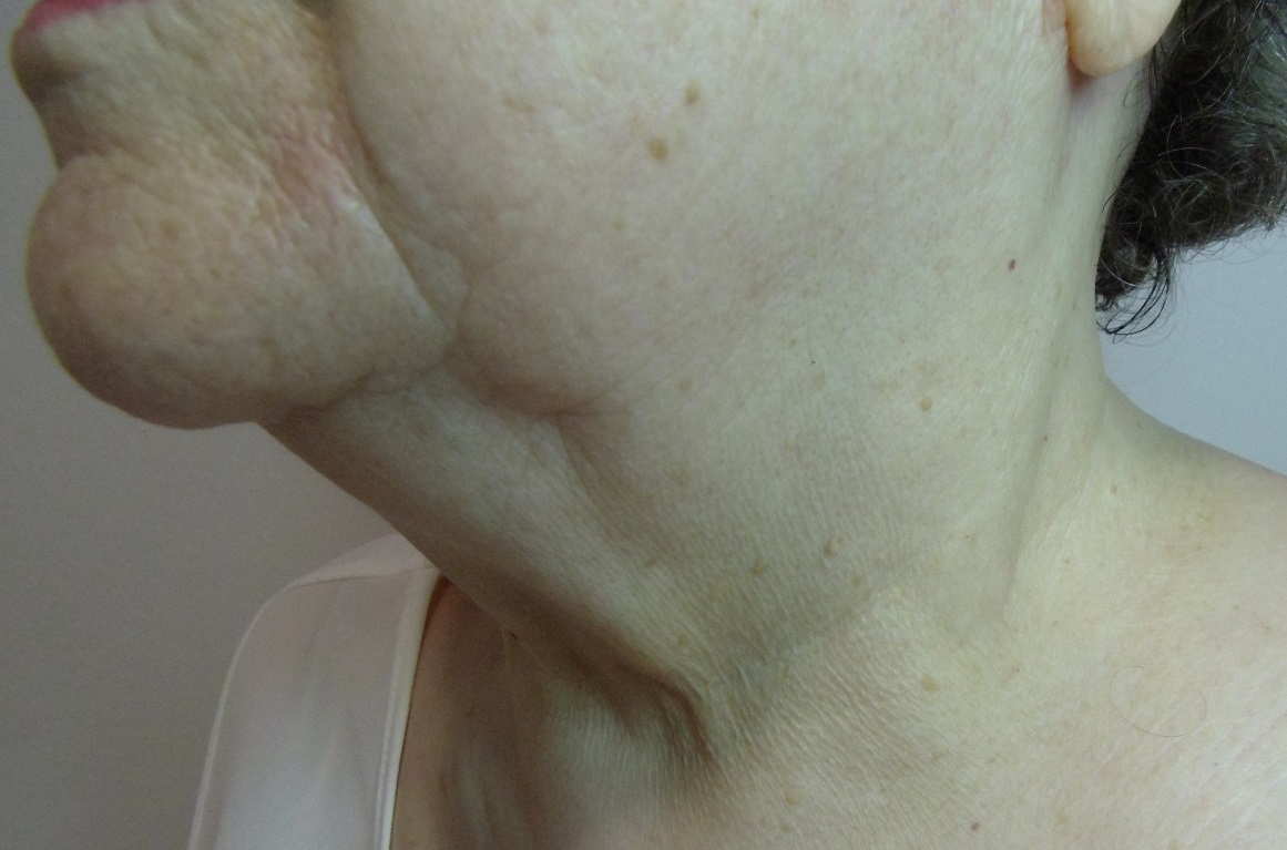 FIBROMAS BLANDOS O PÉNDULOS - Carmen Traseira, medicina estética en Córdoba