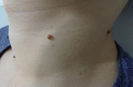 FIBROMAS BLANDOS O PÉNDULOS - Carmen Traseira, medicina estética en Córdoba