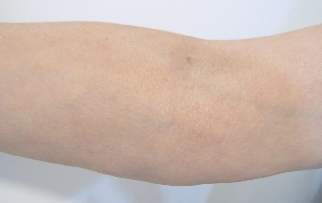 FIBROMAS BLANDOS O PÉNDULOS - Carmen Traseira, medicina estética en Córdoba