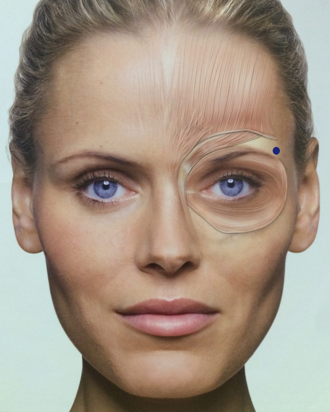 TÉCNICAS PARA ELEVAR LAS CEJAS - Carmen Traseira, medicina estética en ...